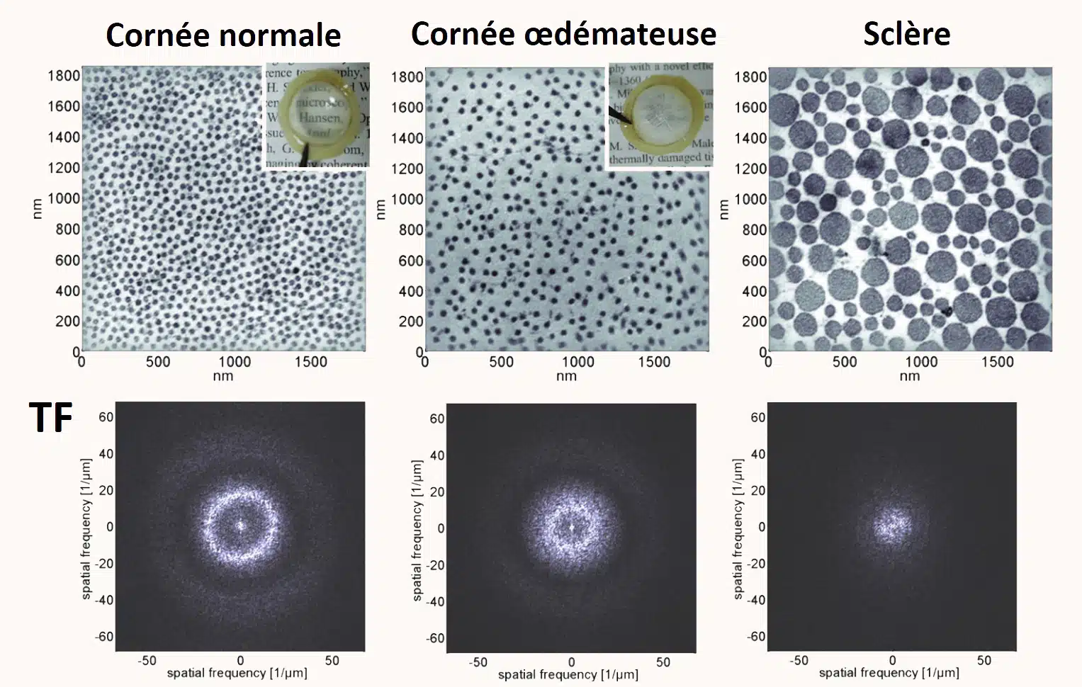 La baisse de vue détectée par des algorithmes - Polytechnique Insights
